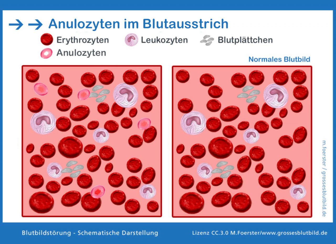 Anulozyten im Blutbild » Fotokunstweb.de